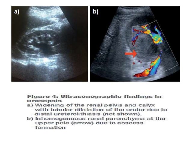 Urosepsis | PPTX | Infectious Diseases | Diseases and Conditions