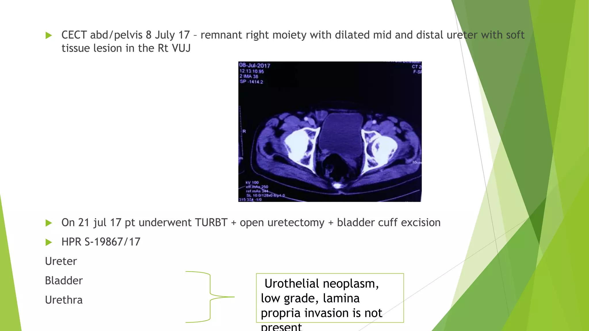 approach to Urothelial carcinoma of upper tract in horse shoe kidney | PPTX