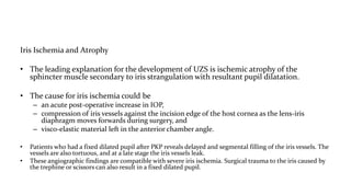 Urrets-Zavalia Syndrome.ophthalmololg pptx | PPTX