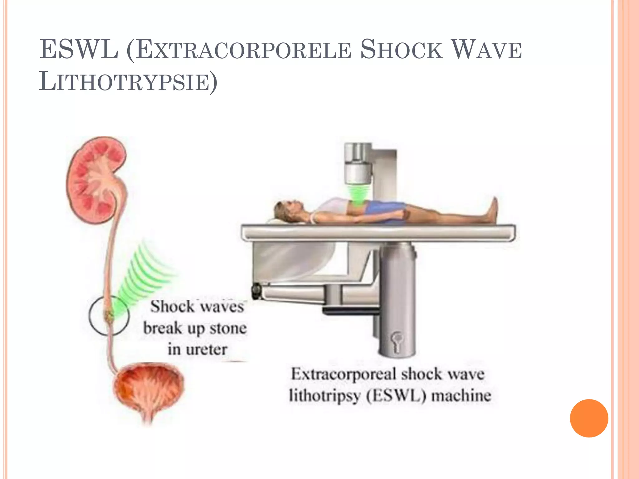 ureterorenoscopie en complicaties | PDF