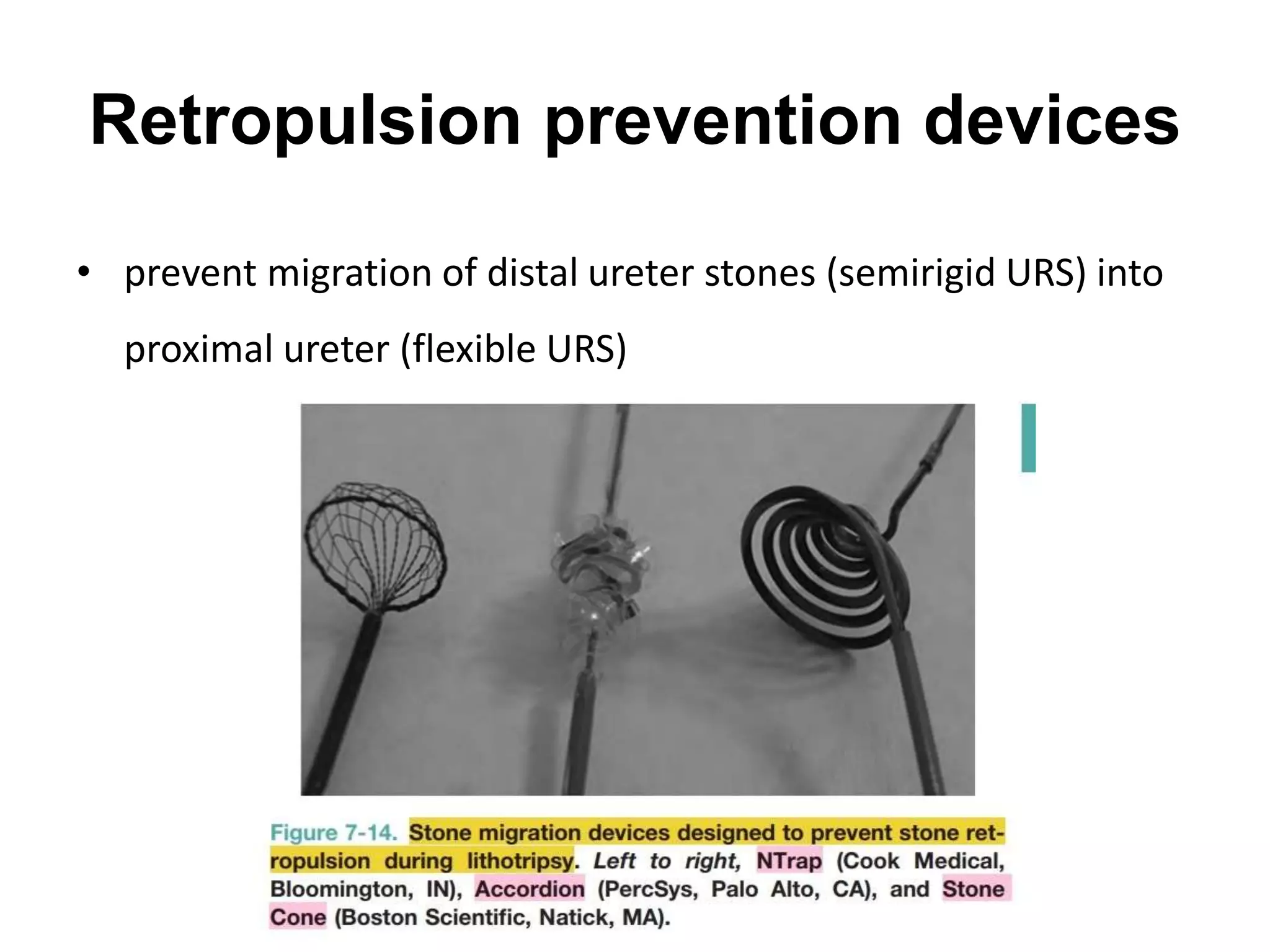 Ureteroscopic lithotripsy (URSL) | PPTX