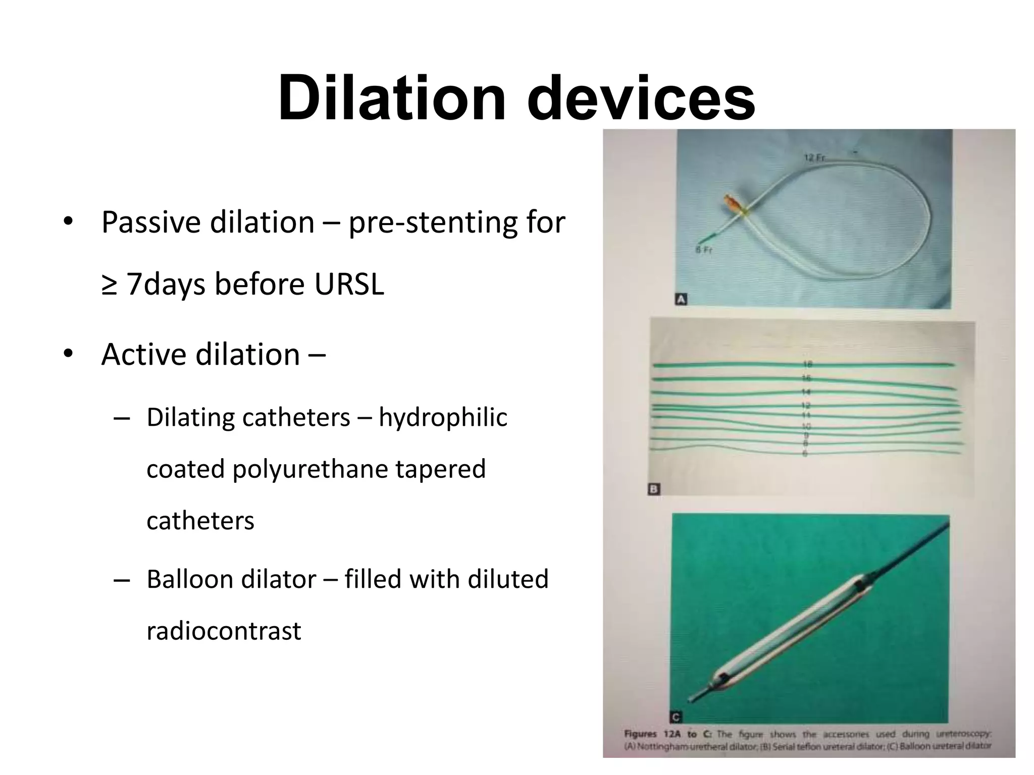 Ureteroscopic lithotripsy (URSL) | PPTX