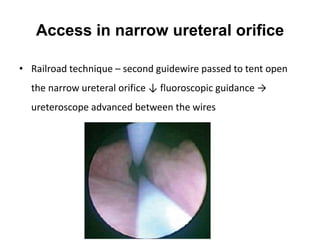 Ureteroscopic lithotripsy (URSL) | PPTX
