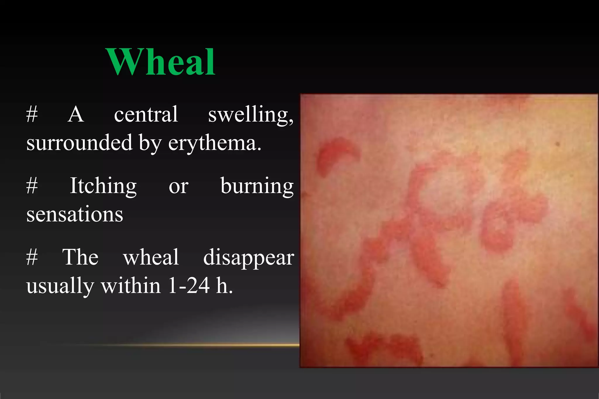 urticaria-140703021029-phpapp02.pptx