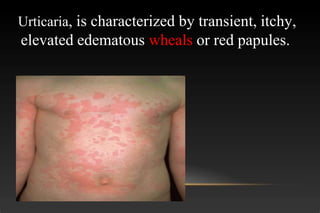 urticaria-140703021029-phpapp02.pptx