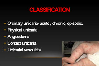 urticaria-140703021029-phpapp02.pptx