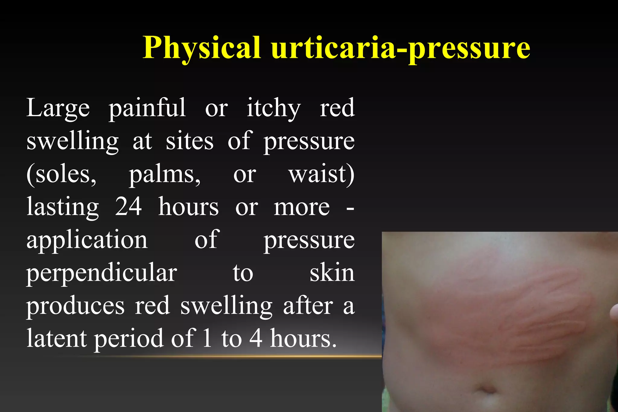 Urticaria | PPT