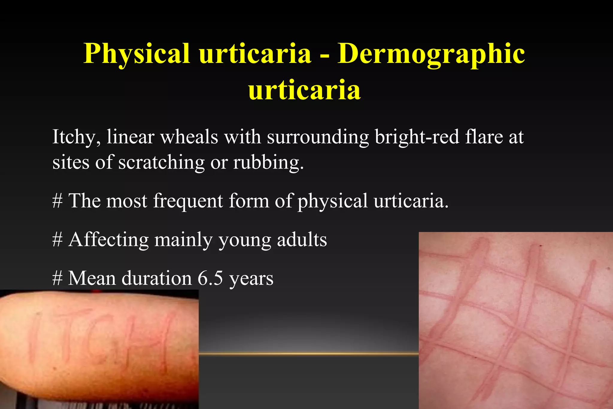 Urticaria | PPT