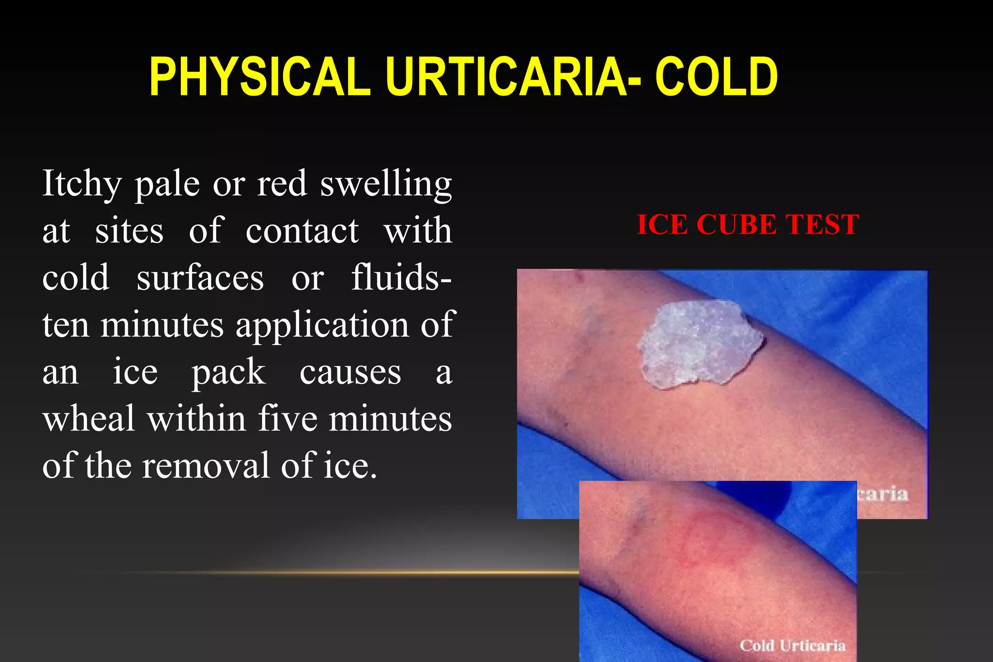 Urticaria | PPT