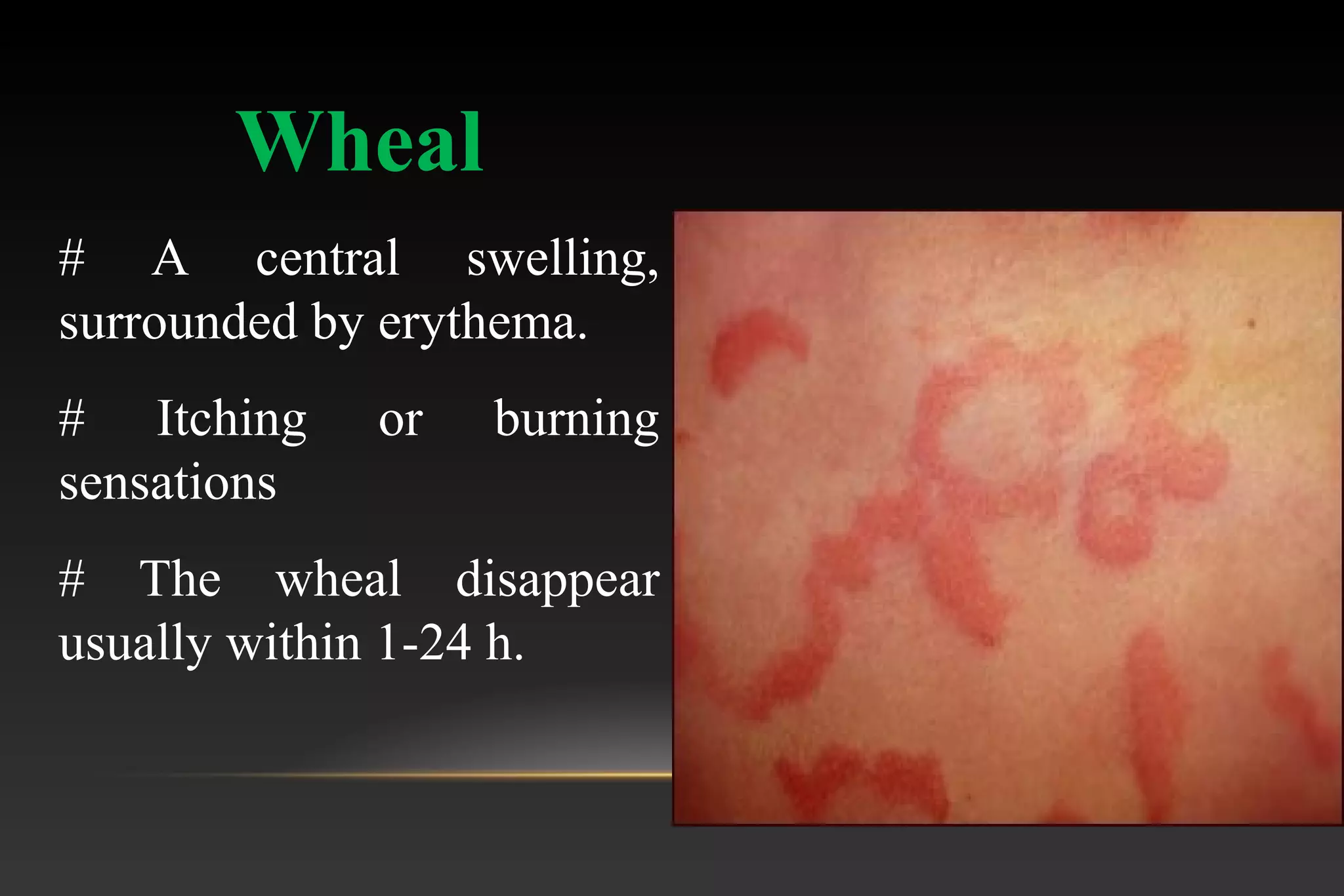 Urticaria | PPT