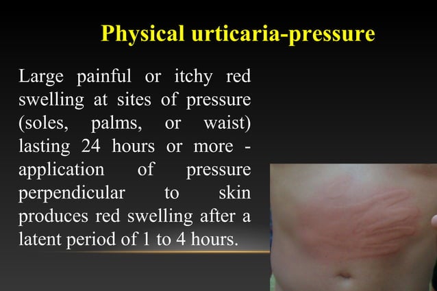 Urticaria | PPT | Allergies | Diseases and Conditions