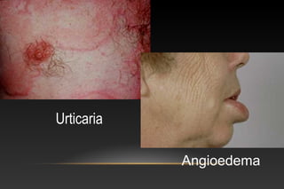 Urticaria | PPT | Allergies | Diseases and Conditions