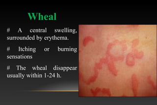 Urticaria | PPT