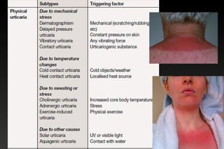 Adrenergic Urticaria