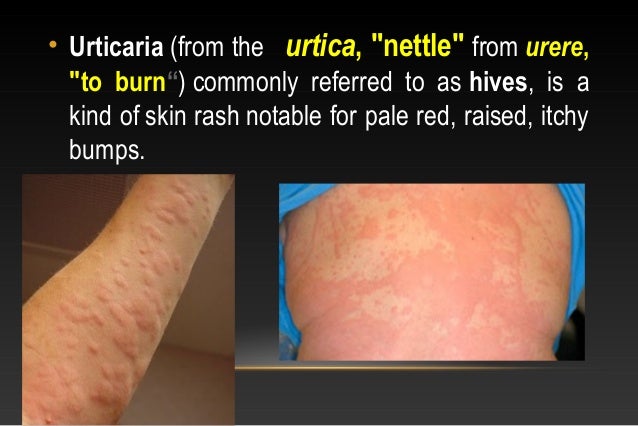 Urticaria