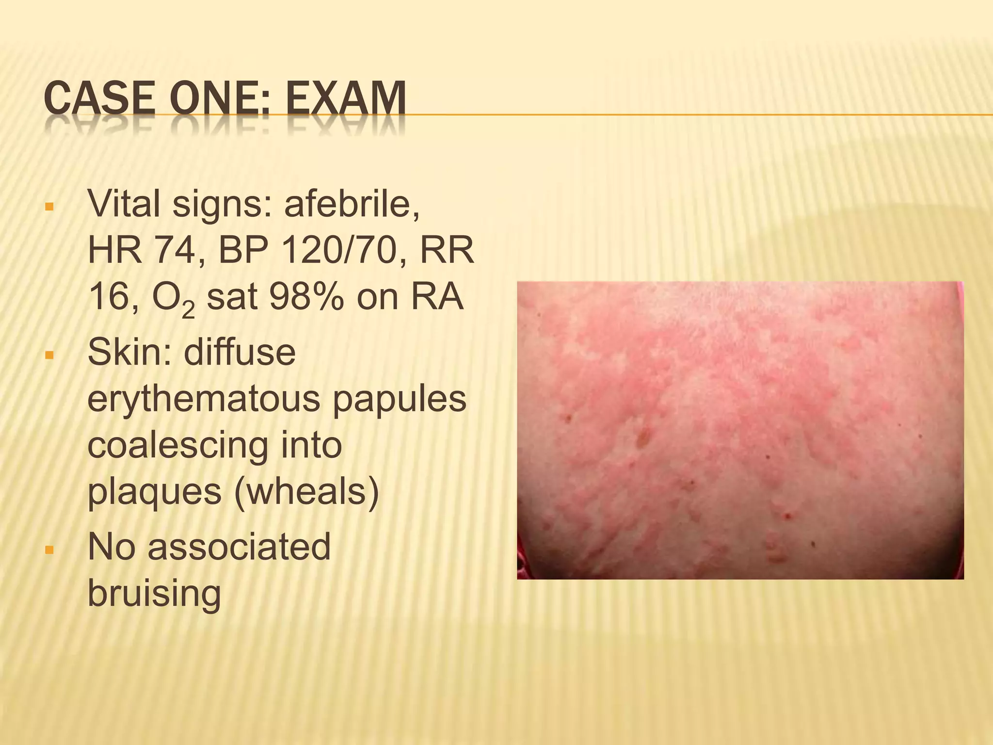 Urticaria | PPTX