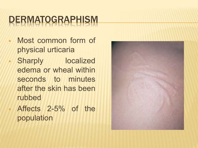 Urticaria | PPTX