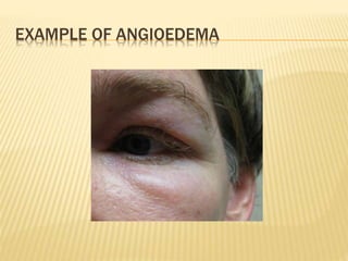 Angioedema Eyes