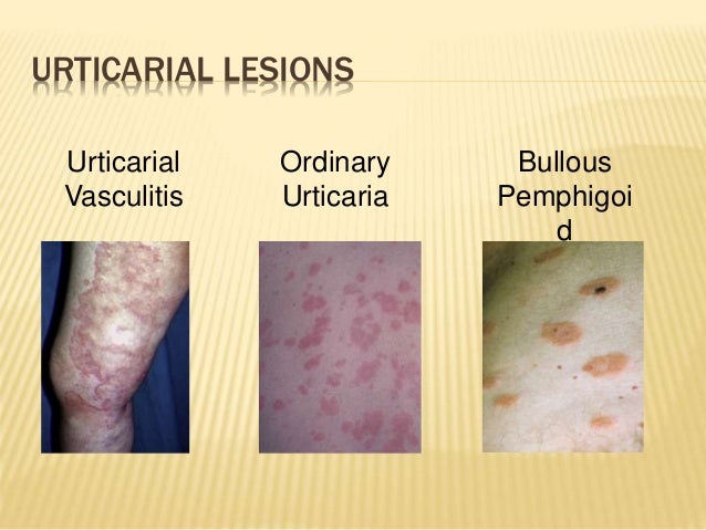 Urticaria