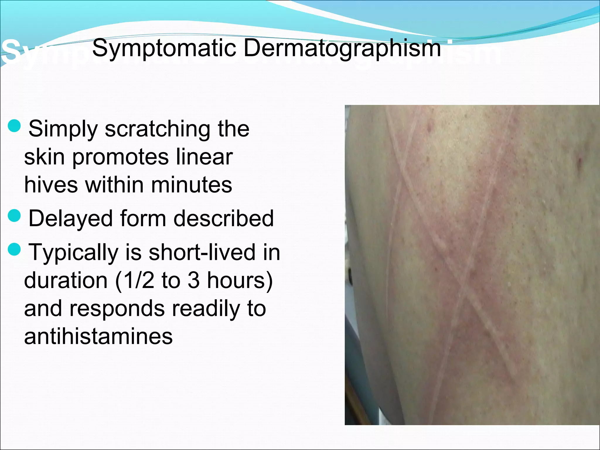 clinical approach to Urticaria AND ANGIODEMA | PPT