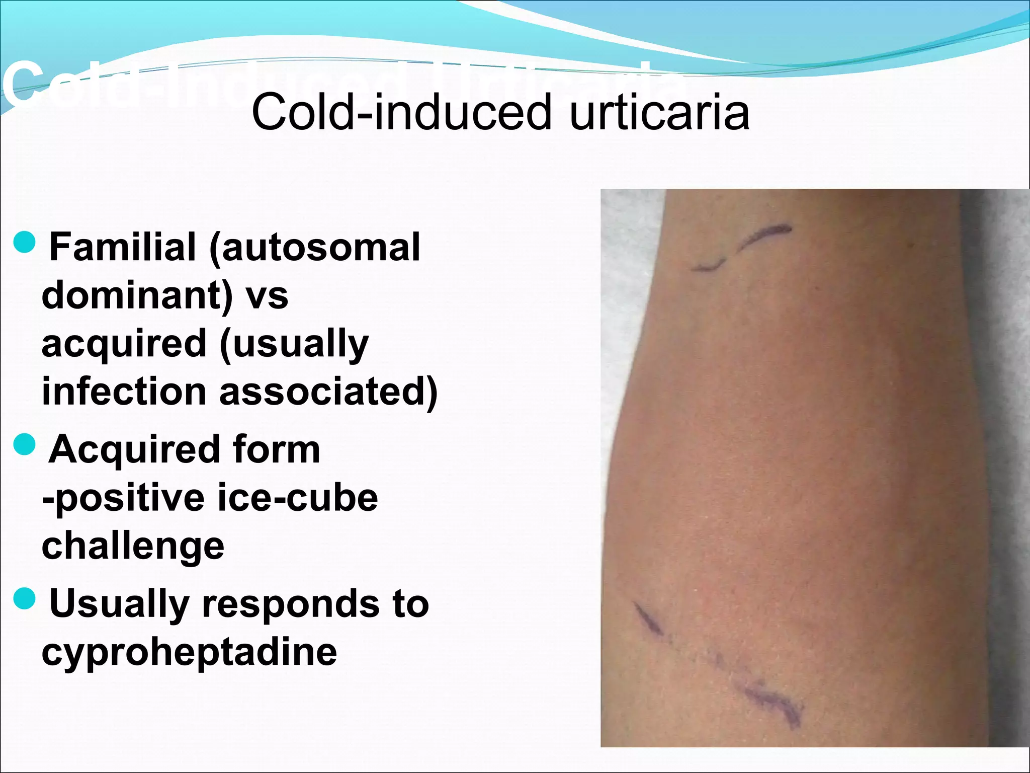 clinical approach to Urticaria AND ANGIODEMA | PPT