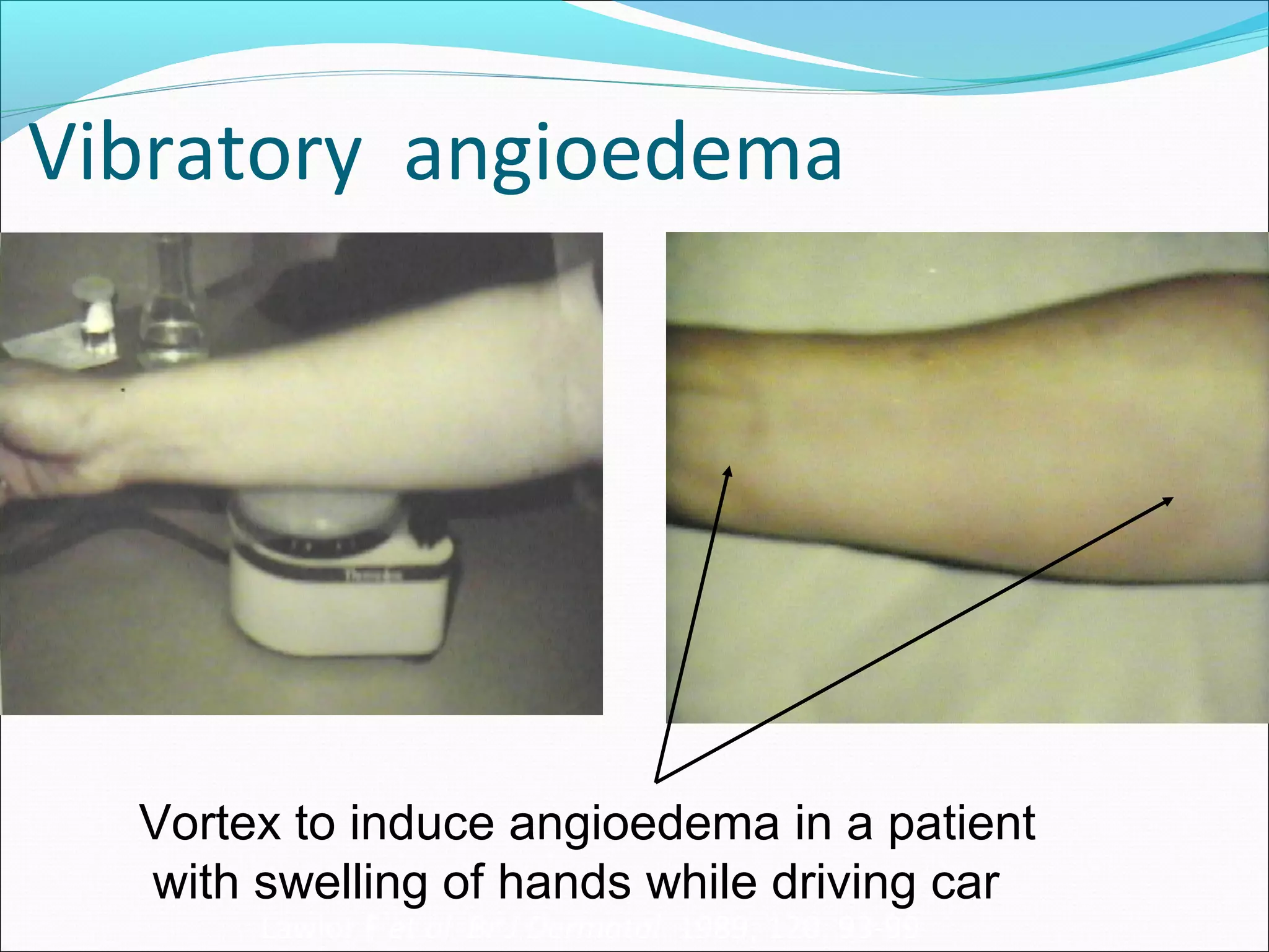 clinical approach to Urticaria AND ANGIODEMA | PPT