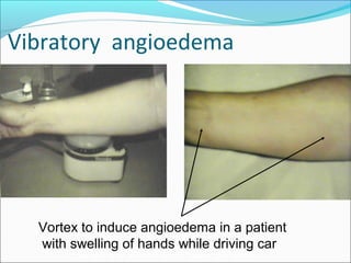 clinical approach to Urticaria AND ANGIODEMA | PPT