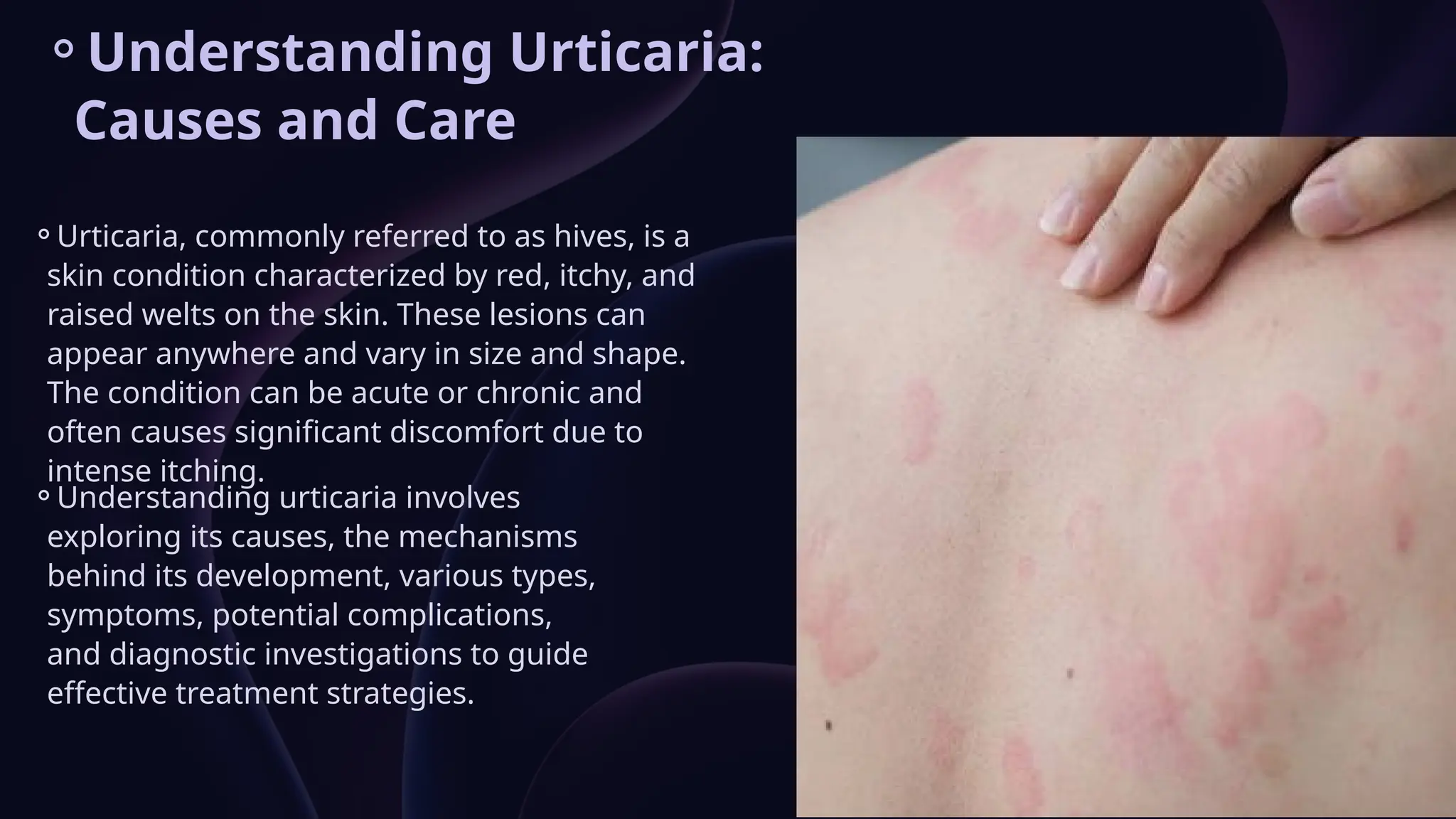 URTICARIA (Hives) and it's types.itiology, diagnosis | PPTX