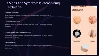 URTICARIA (Hives) and it's types.itiology, diagnosis | PPT