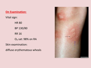 Urticaria - Dr Maryam K Alnajem | PPTX