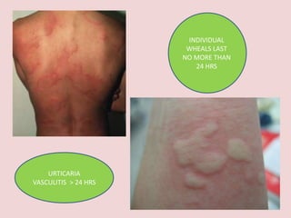 Urticaria - Dr Maryam K Alnajem | PPTX