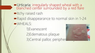 Urticaria | PPTX