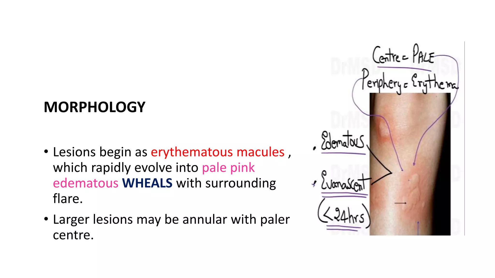 Urticaria clinical features dermatology | PPTX