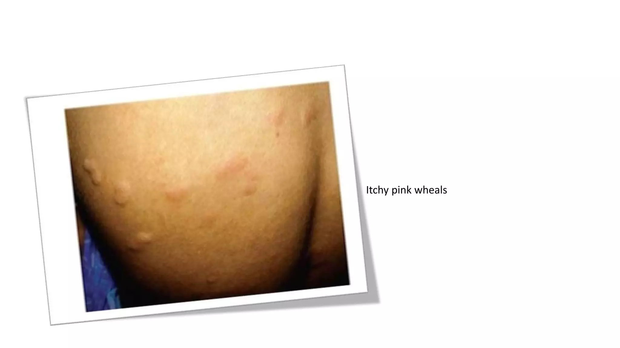 Urticaria clinical features dermatology | PPTX