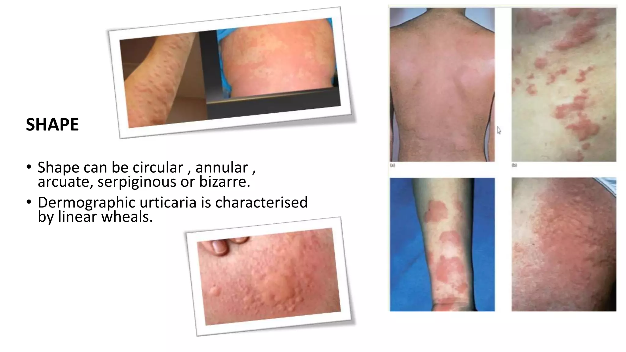 Urticaria clinical features dermatology | PPTX