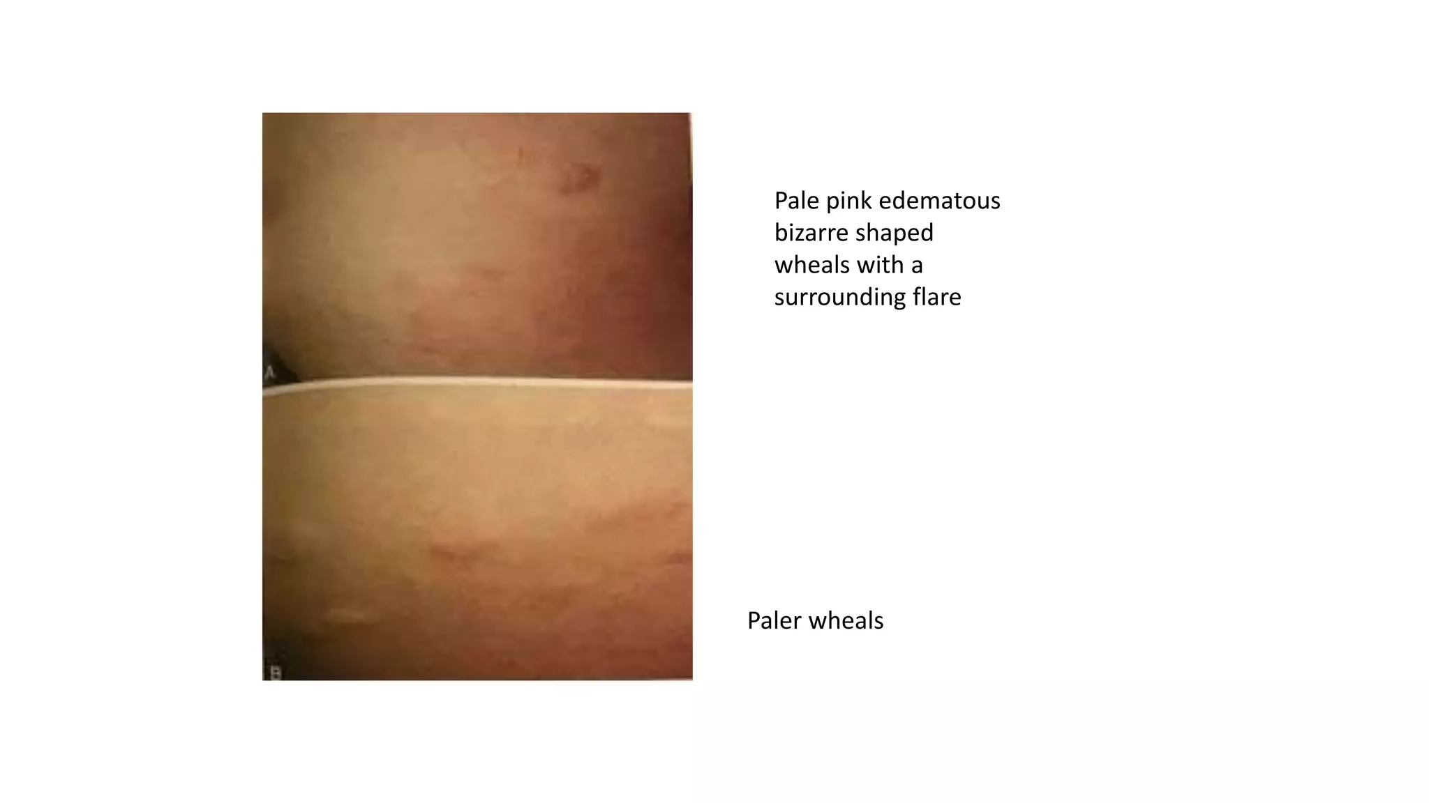 Urticaria clinical features dermatology | PPTX
