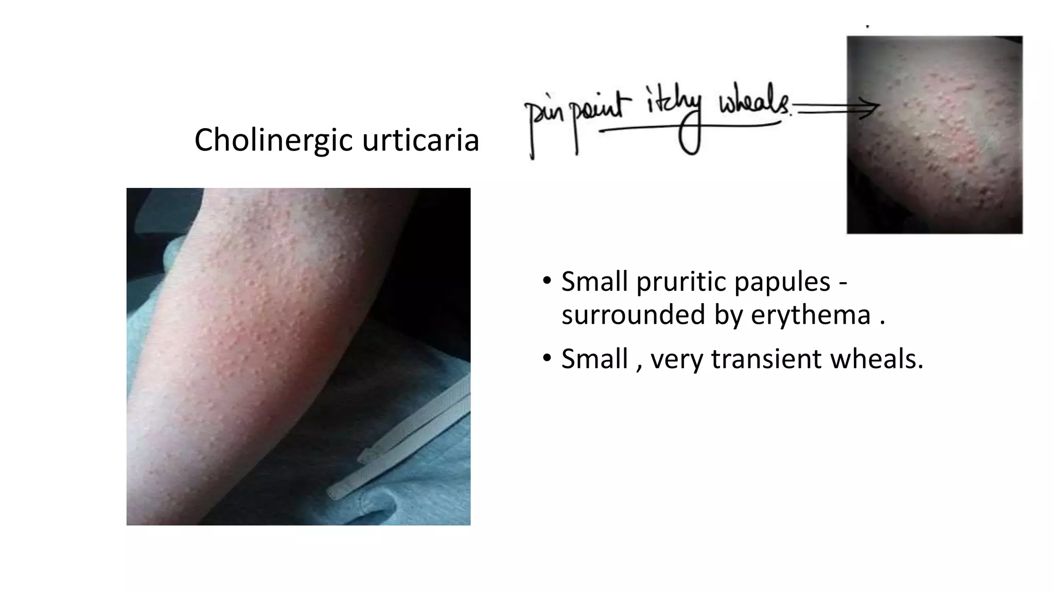 Urticaria clinical features dermatology | PPTX