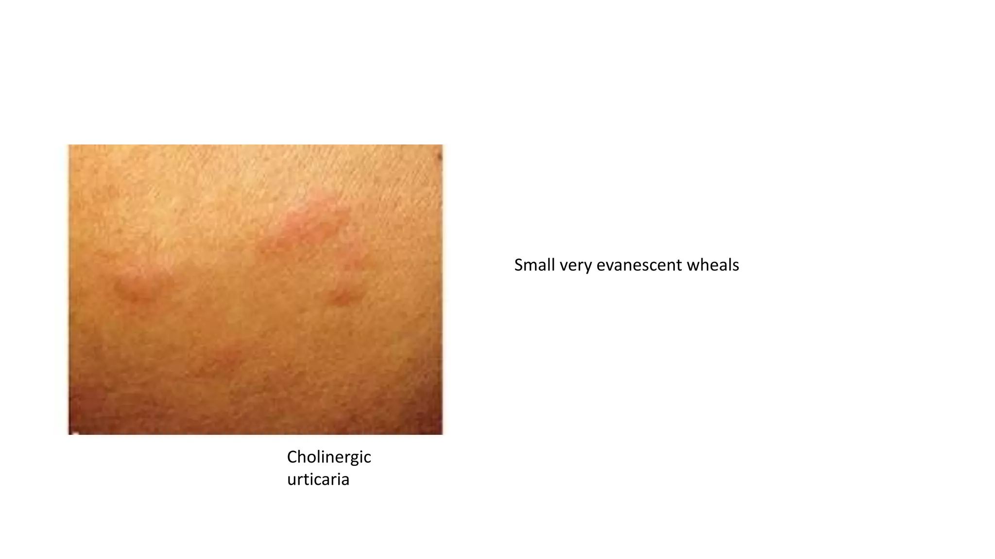 Urticaria clinical features dermatology | PPTX