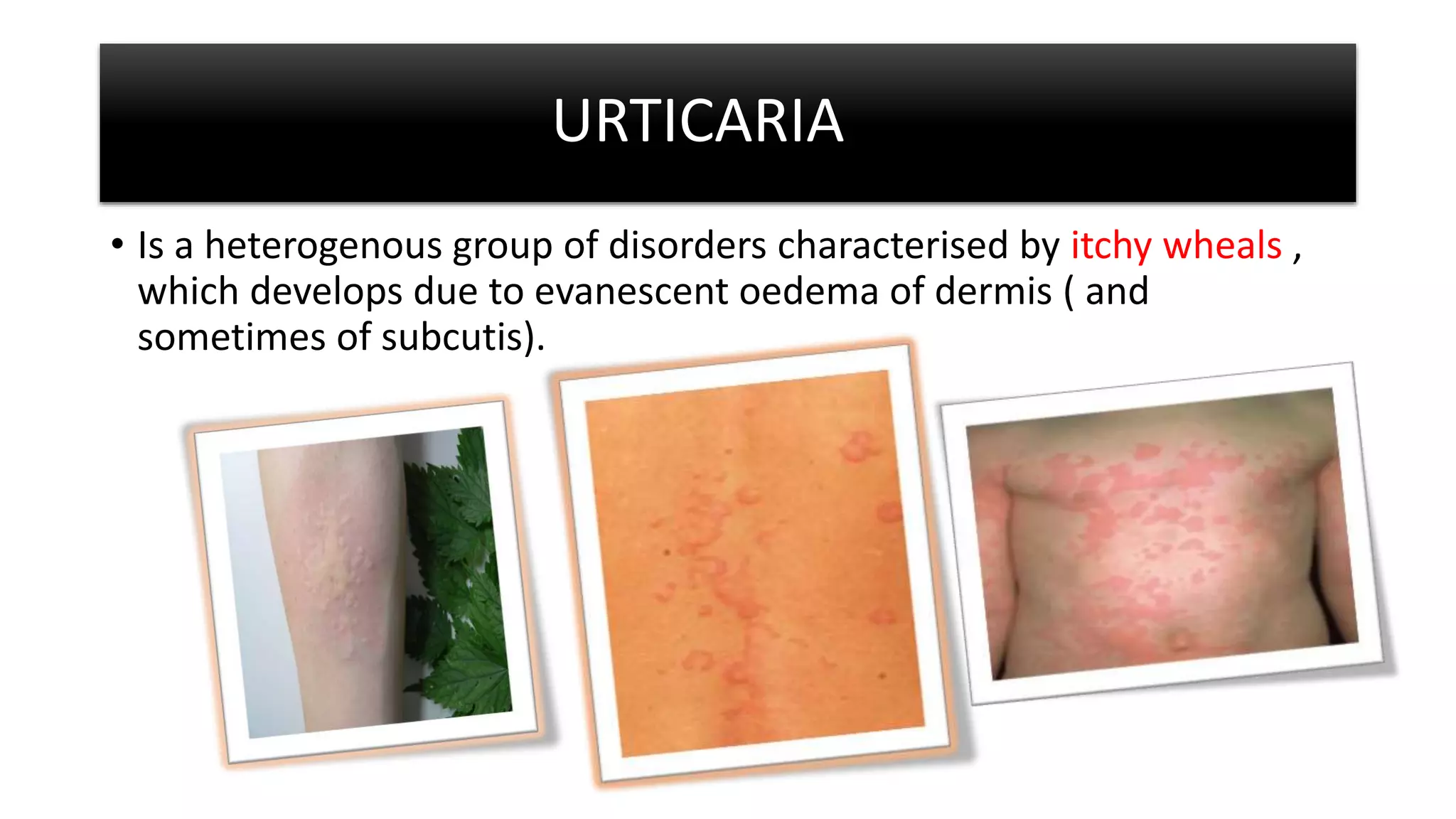 Urticaria clinical features dermatology | PPTX