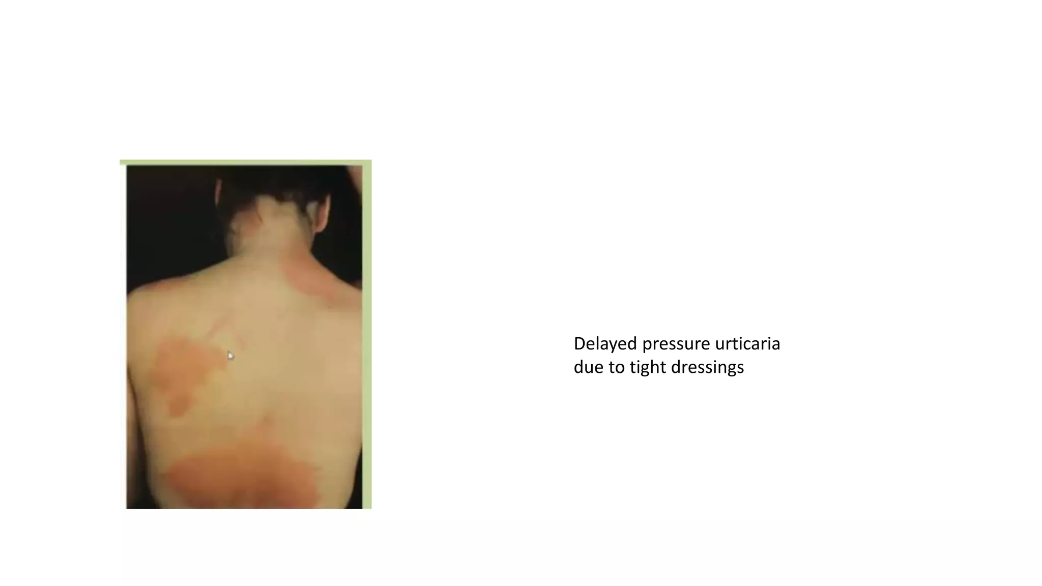 Urticaria clinical features dermatology | PPTX