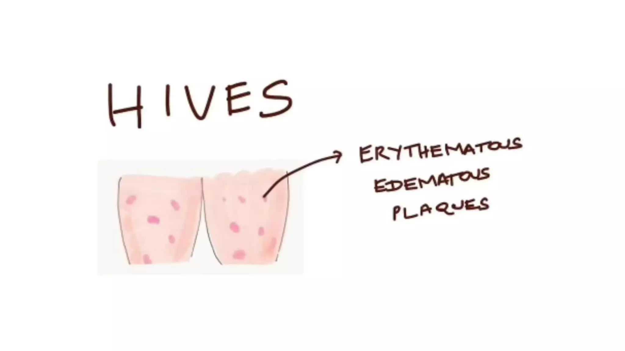 Urticaria clinical features dermatology | PPTX