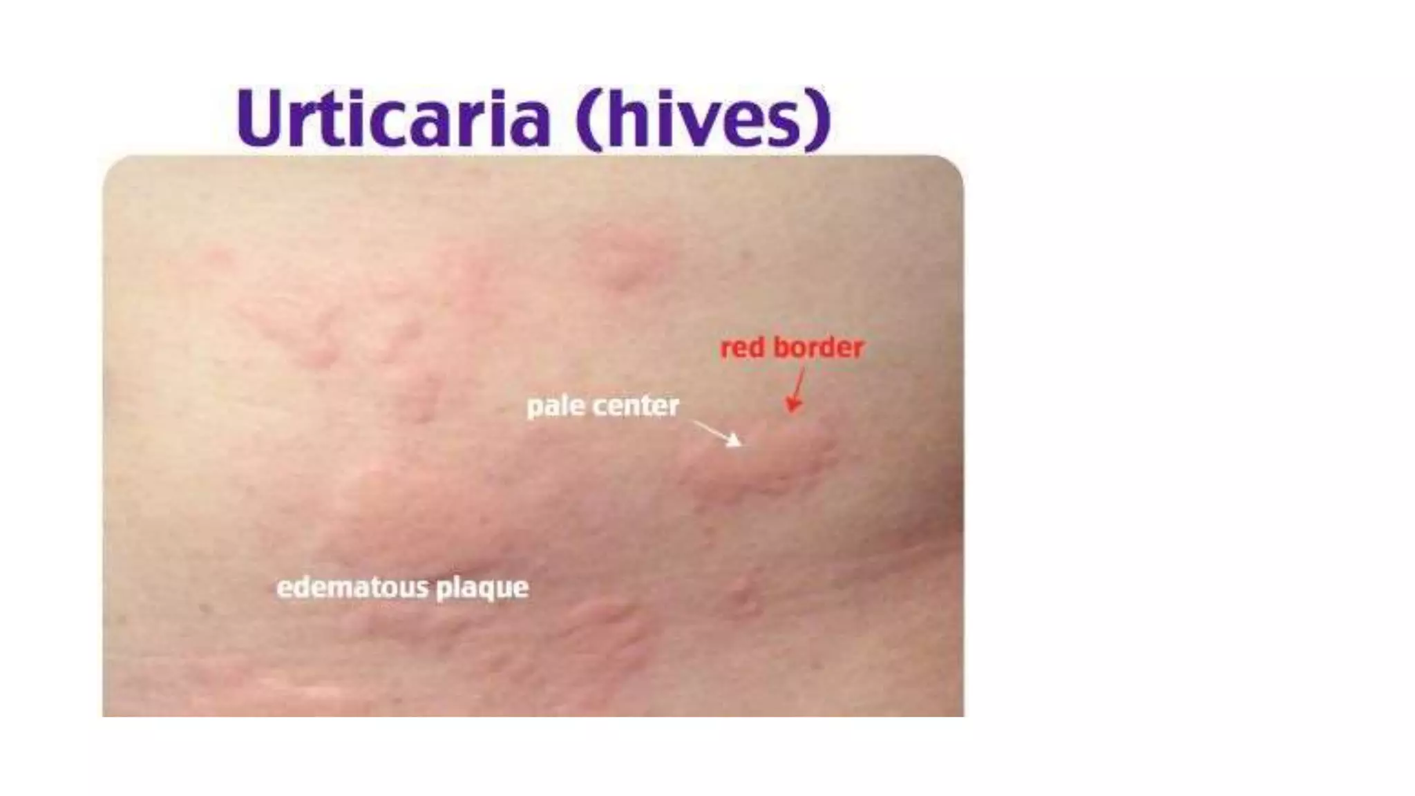 Urticaria clinical features dermatology | PPTX