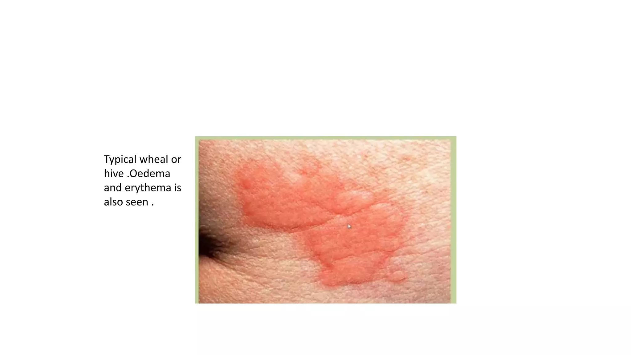 Urticaria clinical features dermatology | PPTX