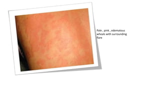 Urticaria clinical features dermatology | PPTX