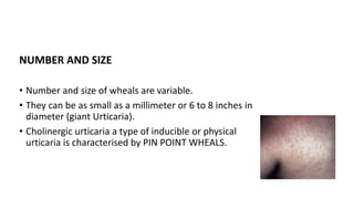 Urticaria clinical features dermatology | PPTX