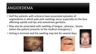 Urticaria clinical features dermatology | PPTX