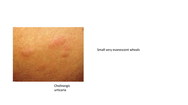 Urticaria clinical features dermatology | PPTX