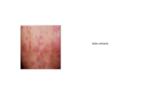 Urticaria clinical features dermatology | PPTX