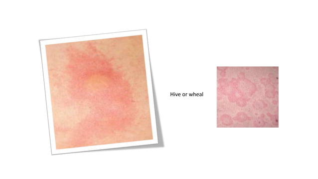 Urticaria clinical features dermatology | PPTX