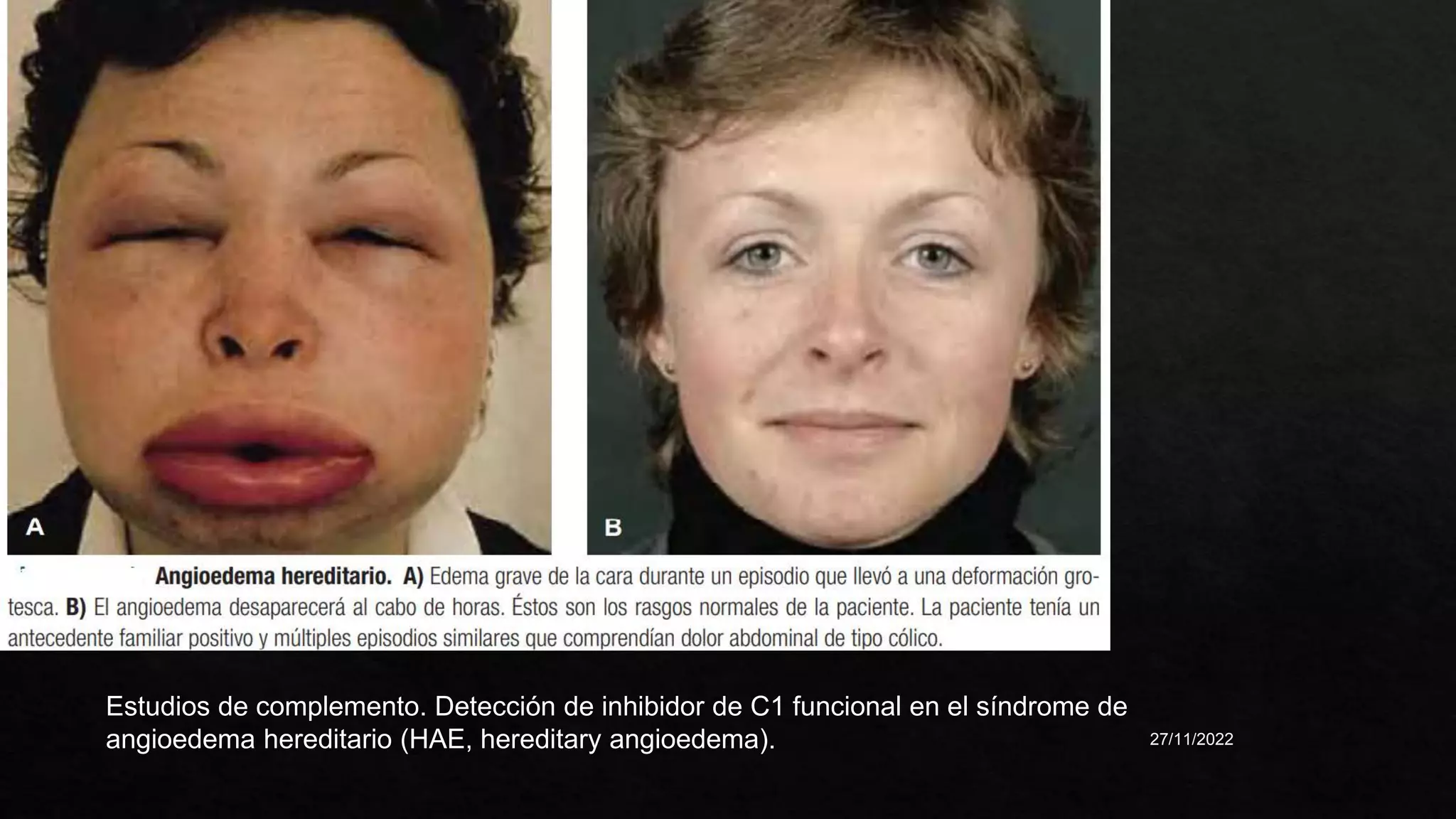 urticaria.pptx
